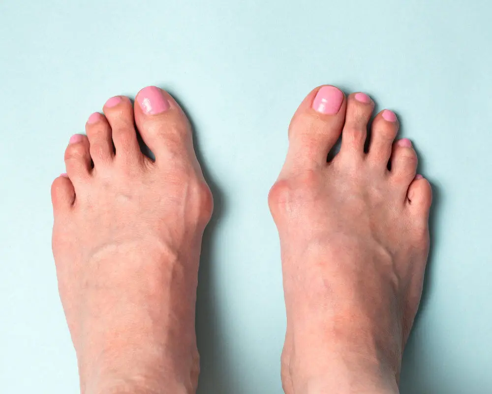 Hallux Rigidus: Symptoms & Causes | Liebscher & Bracht