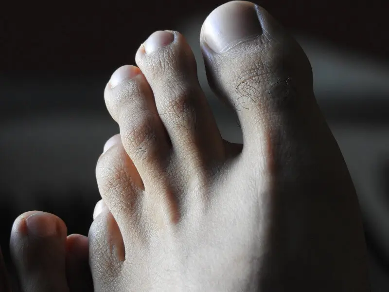 Hallux Rigidus: Symptoms & Causes | Liebscher & Bracht