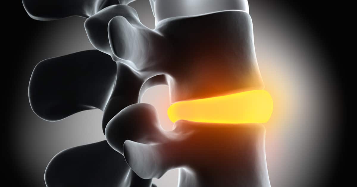 Bulging Disc Exercises 6 Minute Workout | Liebscher & Bracht