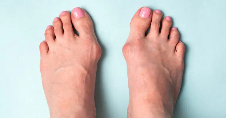 Hammerzehe – Ursachen und effektive Behandlung | Liebscher & Bracht