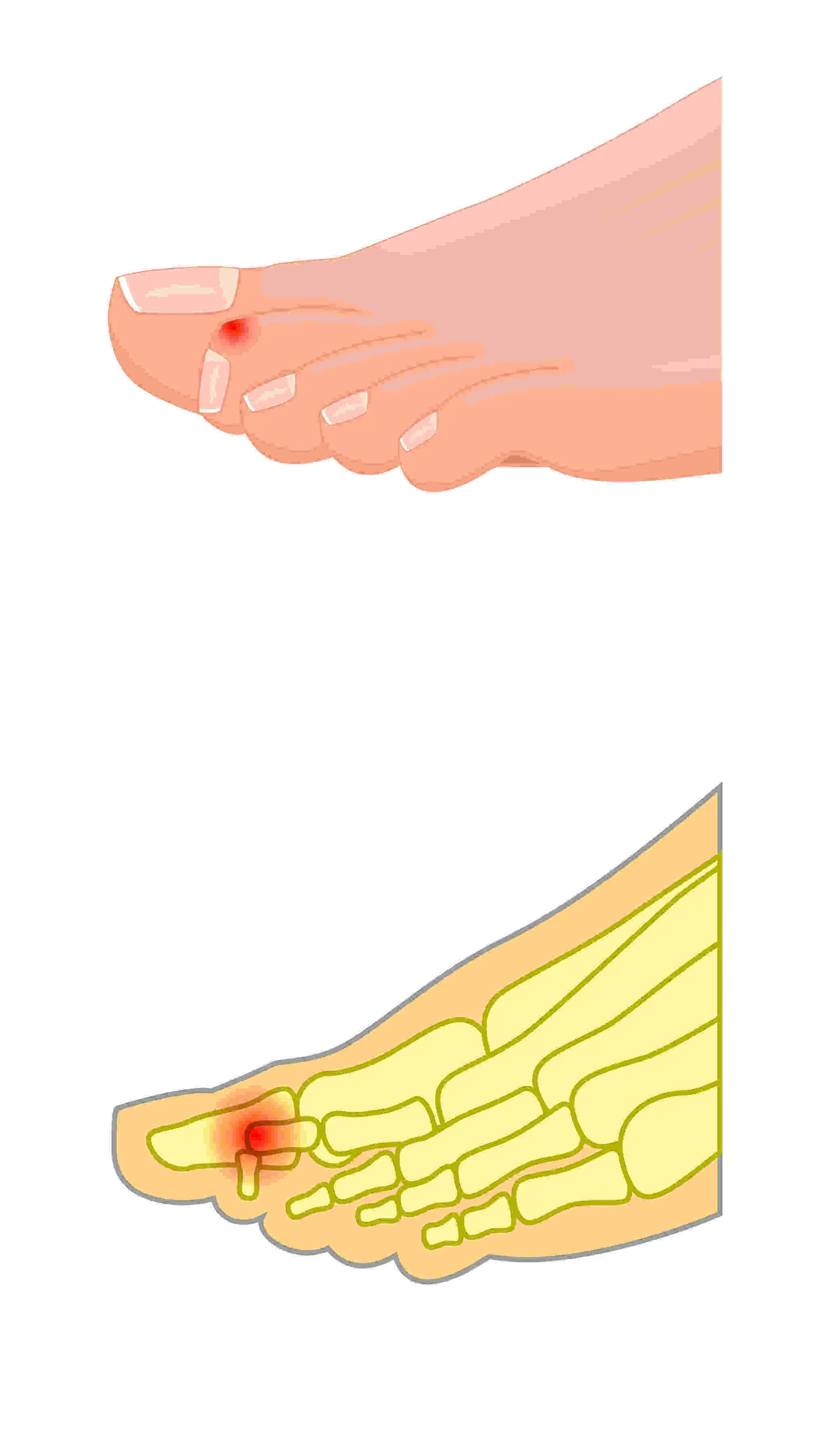 Hammerzehe – Ursachen und effektive Behandlung | Liebscher & Bracht