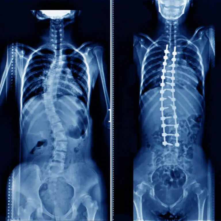 Skoliose — Ursachen, Behandlung und TOP-Übungen | Liebscher & Bracht