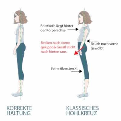 Hohlkreuz – Ursachen & Behandlung | Liebscher & Bracht