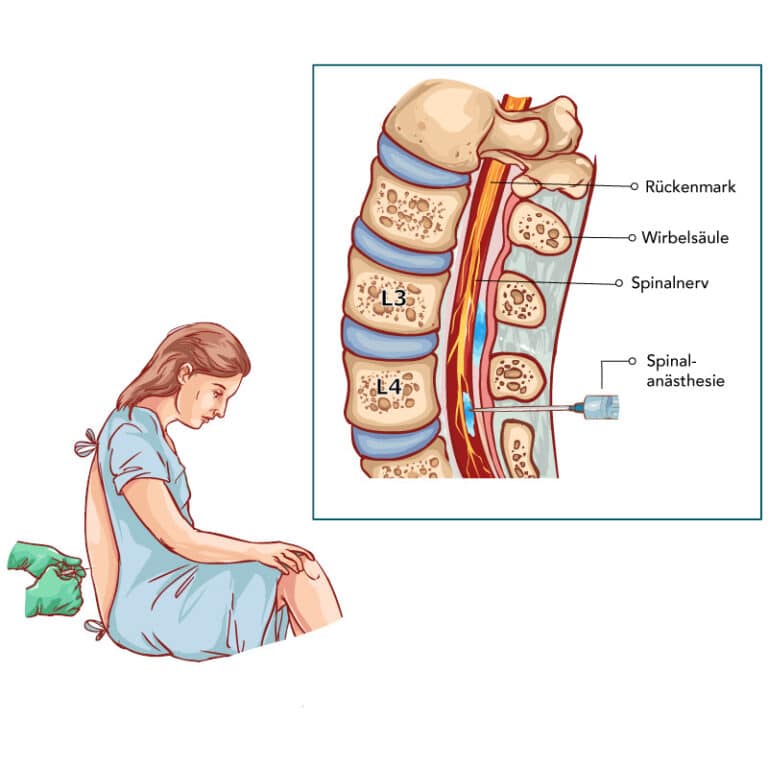 Spondylarthrose & Facettensyndrom stoppen | Liebscher & Bracht