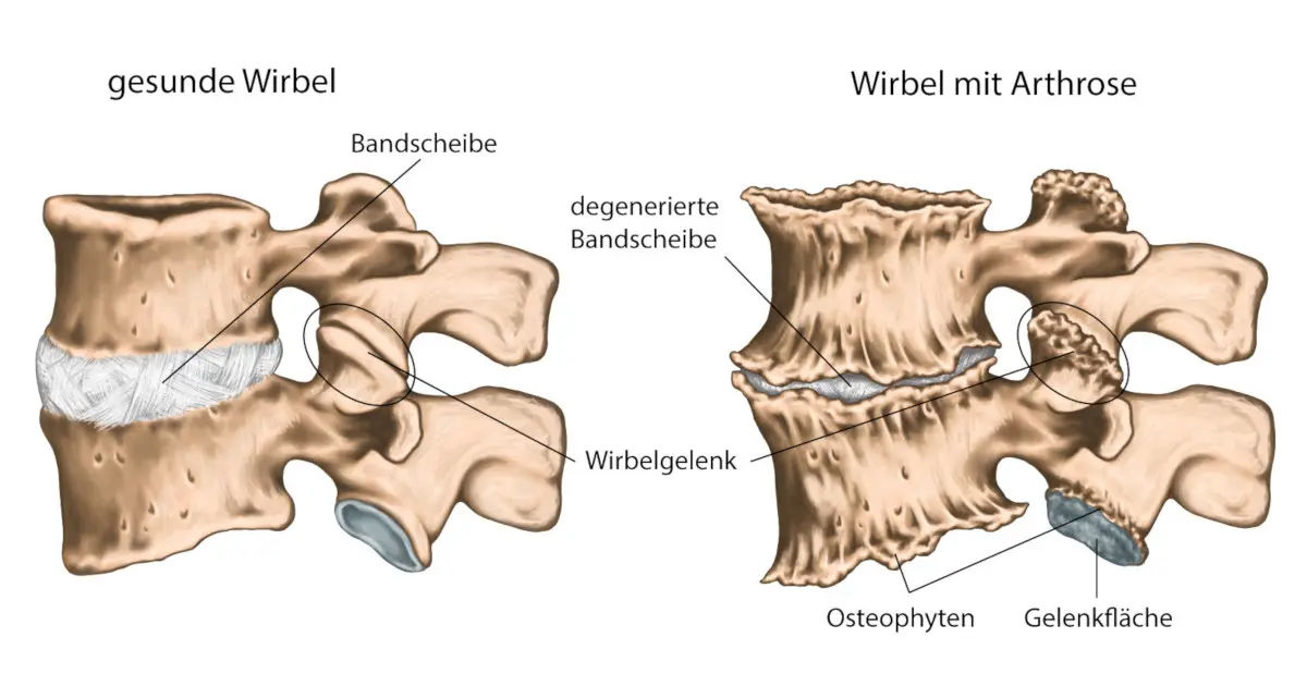 Spondylarthrose & Facettensyndrom stoppen | Liebscher & Bracht