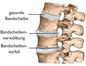 Bandscheibenprotrusion: Symptome & Behandlung | Liebscher & Bracht