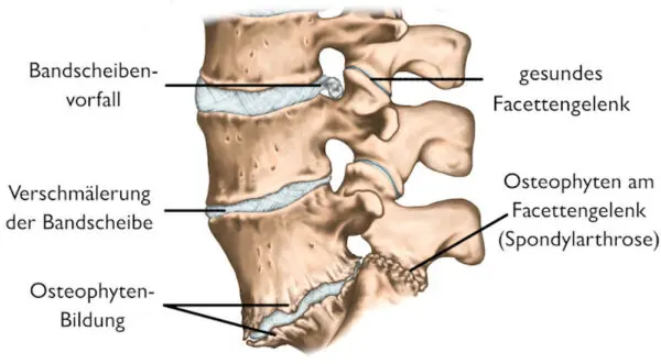 Bandscheibenprotrusion: Symptome & Behandlung | Liebscher & Bracht
