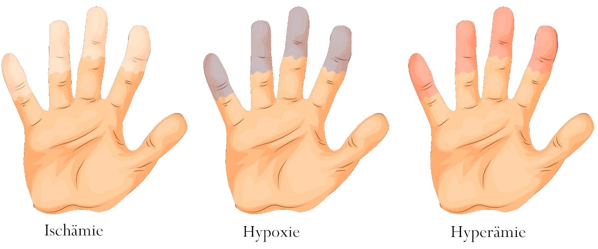 Raynaud-Syndrom – Was hilft gegen das plötzliches Erblassen der Finger ...