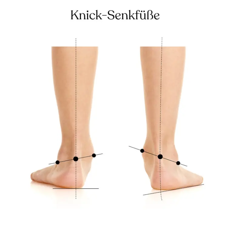 X-Beine bei Kindern und Erwachsenen behandeln | Liebscher & Bracht