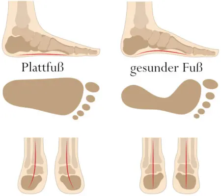 Plattfuß – Hilfe bei Schmerzen durch eine aufliegende Fußsohle ...