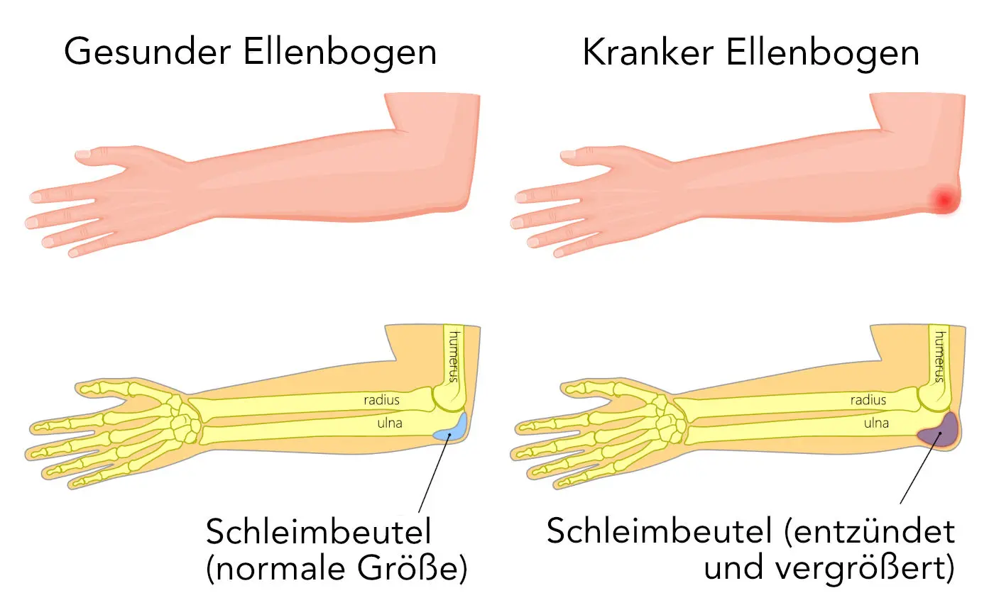 Schmerzen im Ellenbogen: Ursachen & Übungen | Liebscher & Bracht