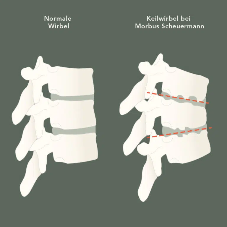 Morbus Scheuermann: Teste diese Übungen | Liebscher & Bracht