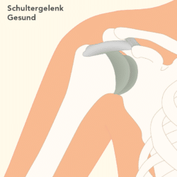 Schulterarthrose (Omarthrose) – Entstehung und Behandlung | Liebscher ...