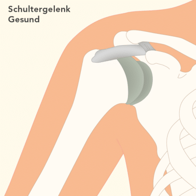 Schulterarthrose (Omarthrose) – Entstehung und Behandlung | Liebscher ...