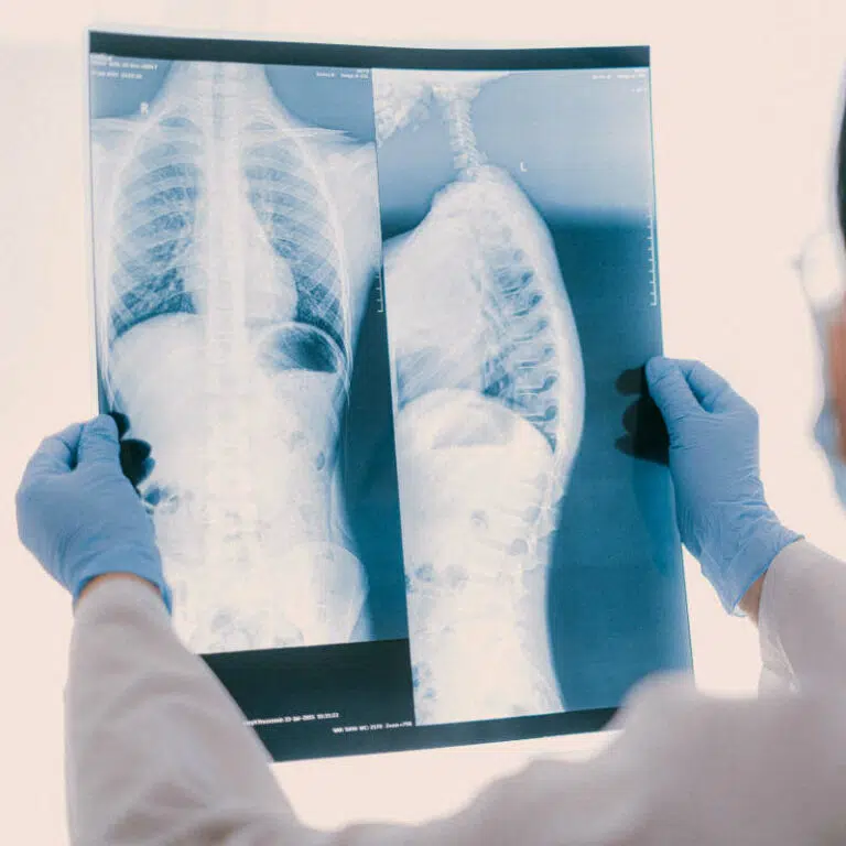 Morbus Scheuermann: Teste diese Übungen | Liebscher & Bracht