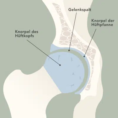 Was ist Coxarthrose? Definition, Stadien & Ursachen | Liebscher & Bracht