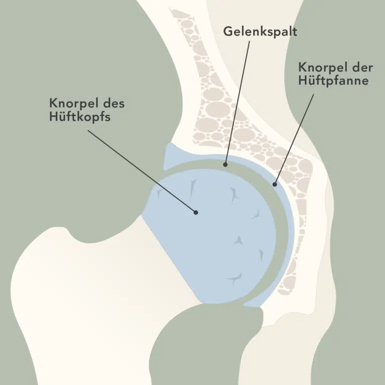 Was ist Coxarthrose? Definition, Stadien & Ursachen | Liebscher & Bracht