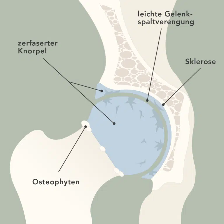 Was ist Coxarthrose? Definition, Stadien & Ursachen | Liebscher & Bracht
