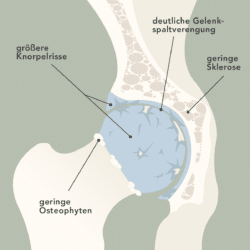 Was ist Coxarthrose? Definition, Stadien & Ursachen | Liebscher & Bracht