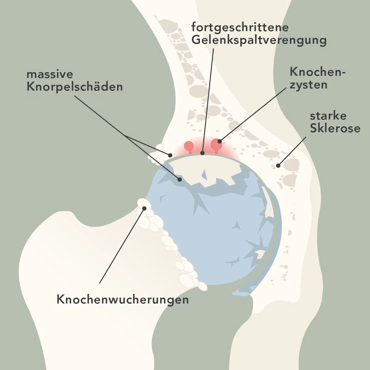 Was ist Coxarthrose? Definition, Stadien & Ursachen | Liebscher & Bracht