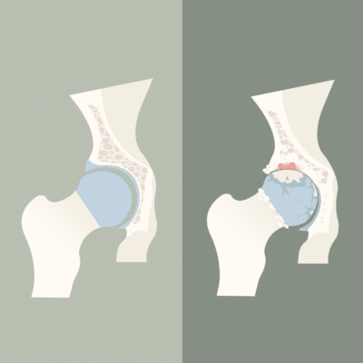 Coxarthrose (Hüftarthrose) | Liebscher & Bracht