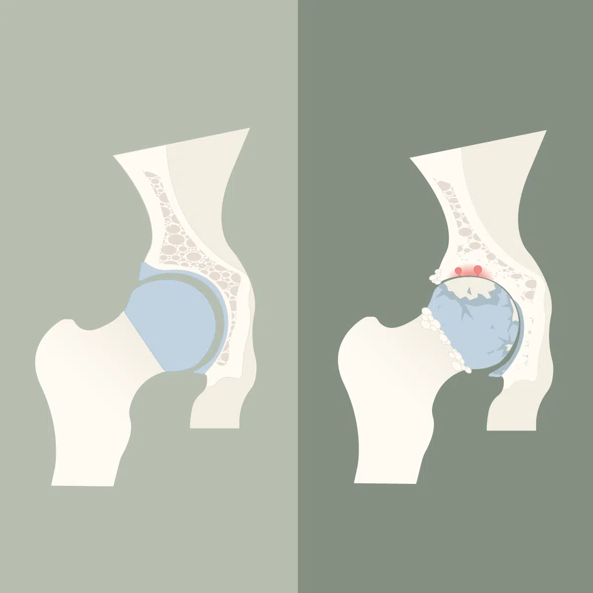 Coxarthrose (Hüftarthrose) | Liebscher & Bracht