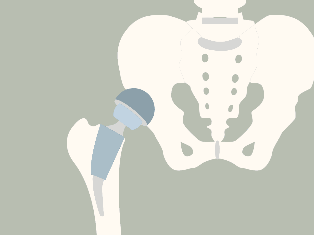 Coxarthrose (Hüftarthrose) | Liebscher & Bracht