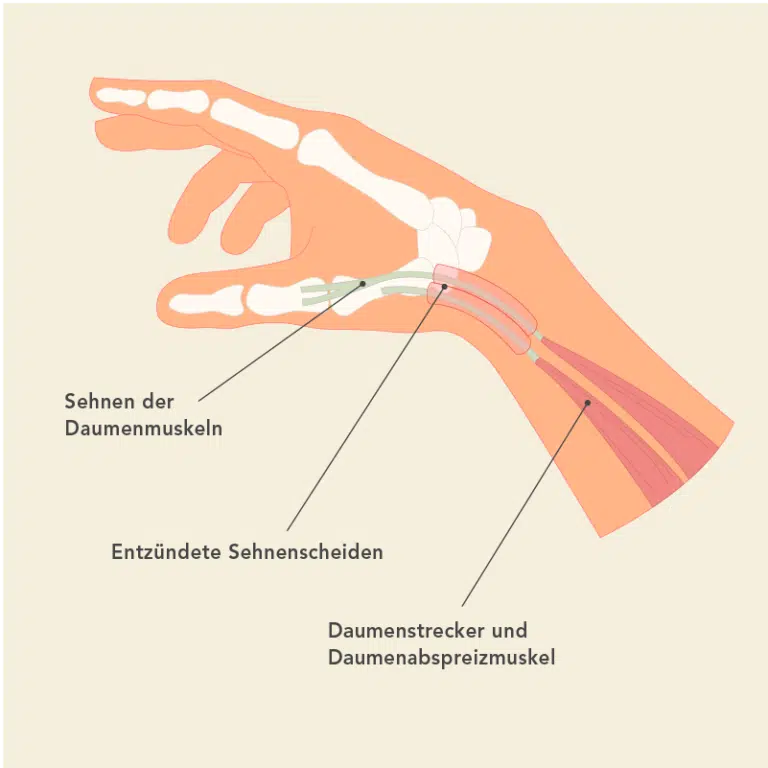 Schmerzen im Daumen | Liebscher & Bracht