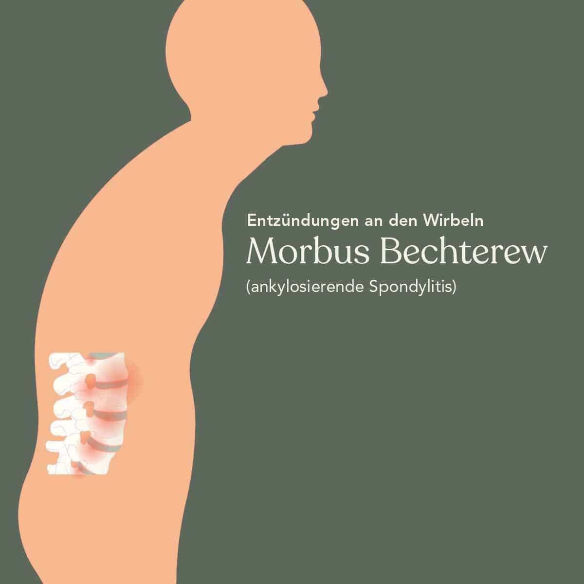 Morbus Bechterew (Spondylitis ankylosans) | Liebscher & Bracht