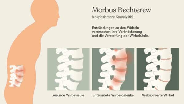 Morbus Bechterew (Spondylitis ankylosans) | Liebscher & Bracht
