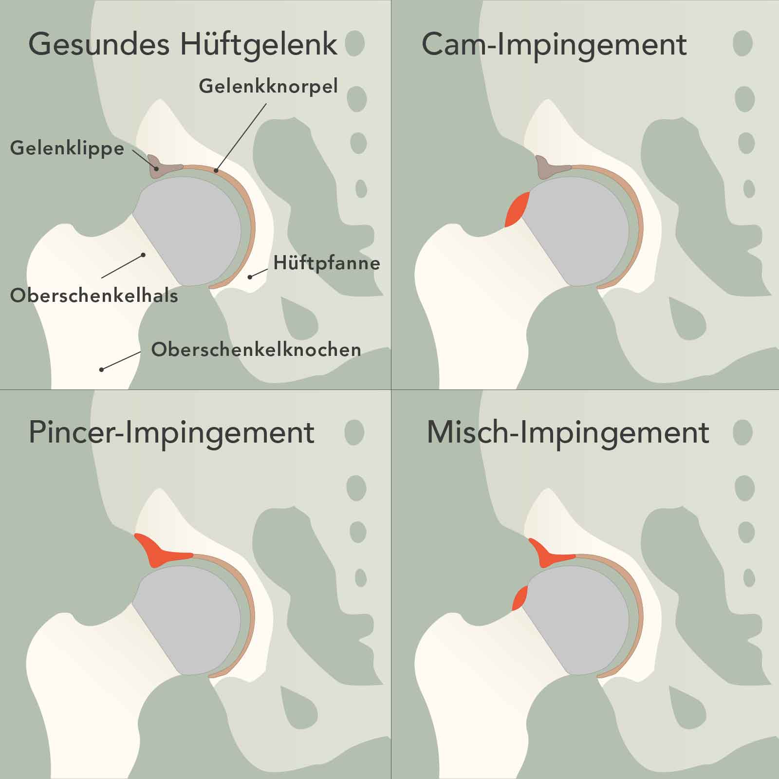 Impingement der Hüfte: Das musst du wissen! | Liebscher & Bracht