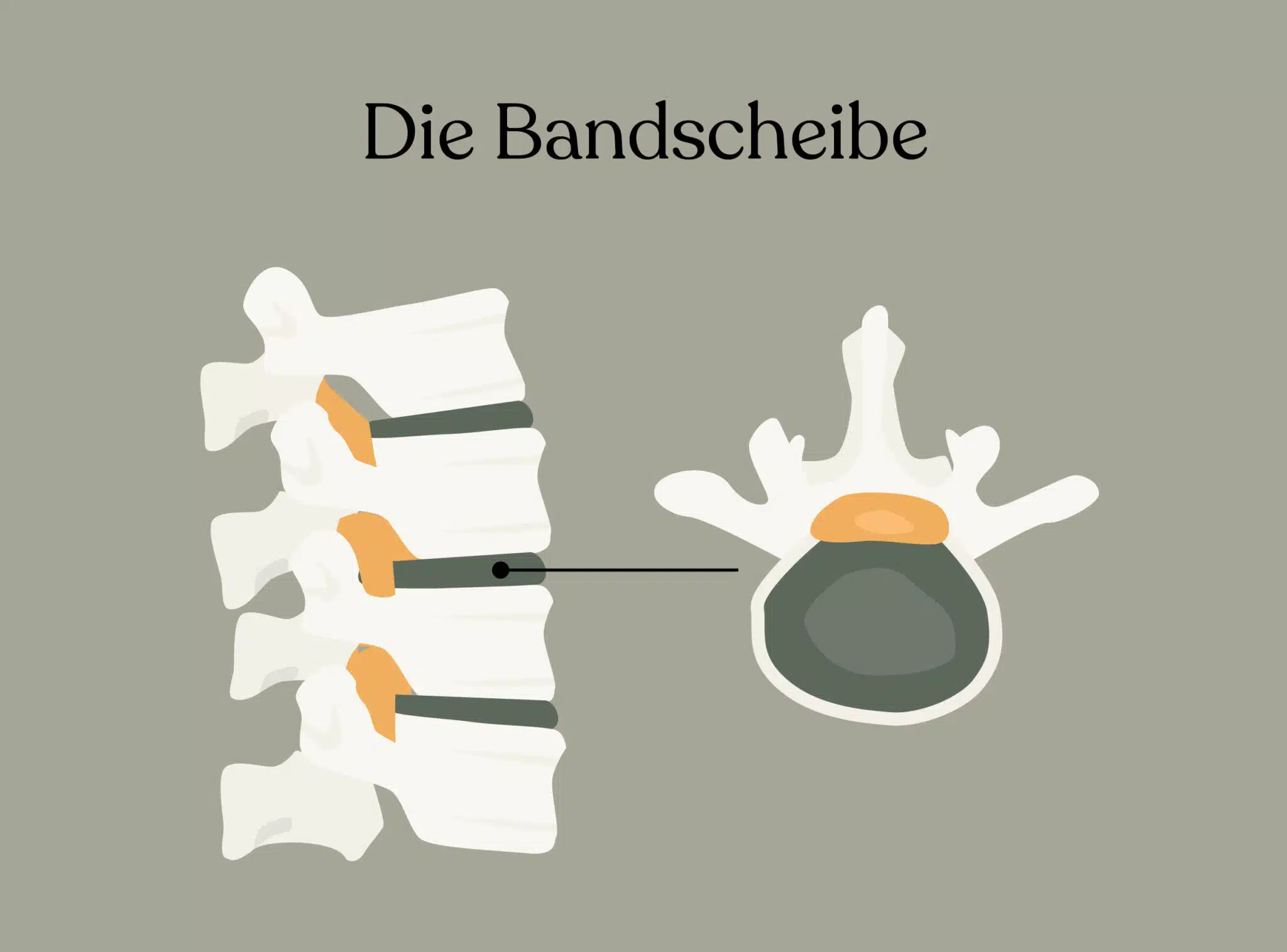 Bandscheibenvorfall verstehen: Ursachen, Behandlung, Prävention