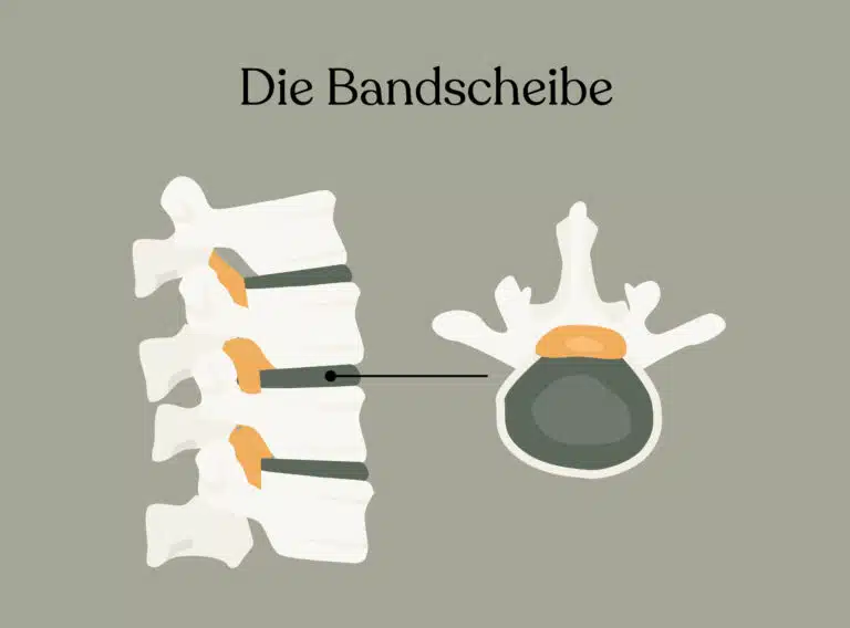 Bandscheibenvorfall verstehen: Ursachen, Behandlung, Prävention