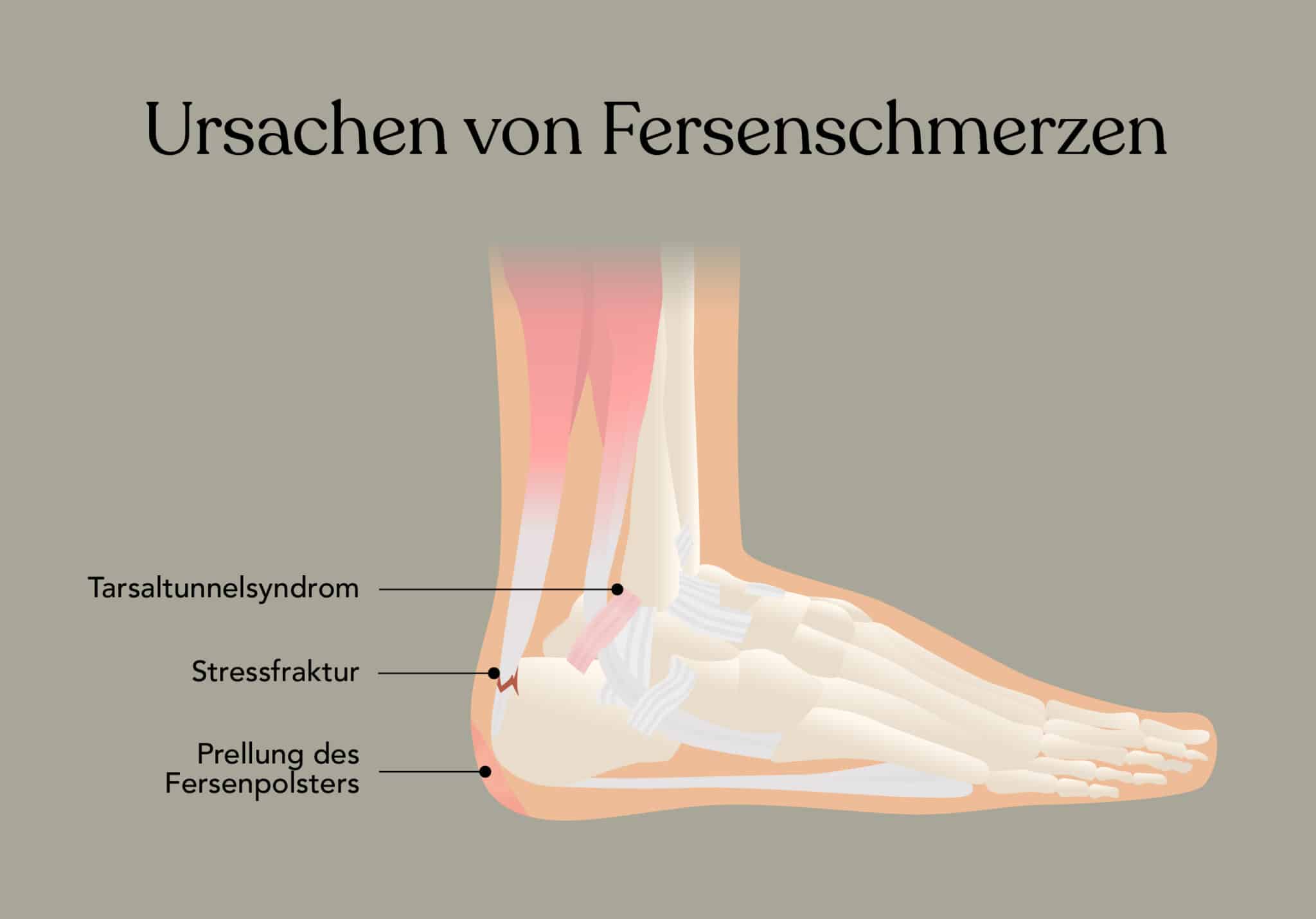 Akute Fersenschmerzen: Symptome, Diagnose & Behandlung