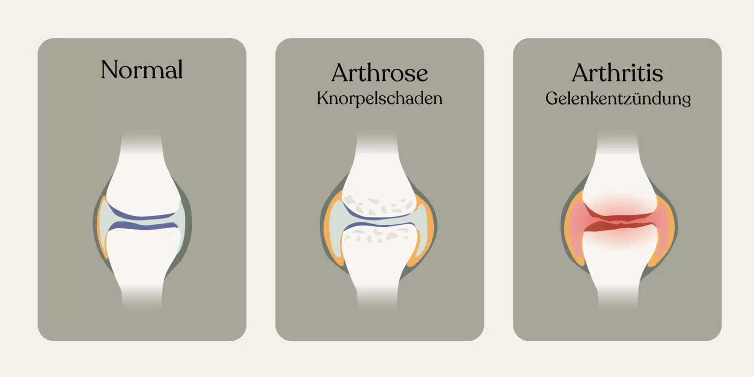 Arthrose verstehen: Die wichtigsten Fakten und hilfreiche Tipps