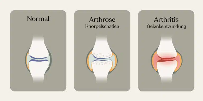 Denkanstöße Ursachen Der Arthrose Und Arthritis ! – SJIS