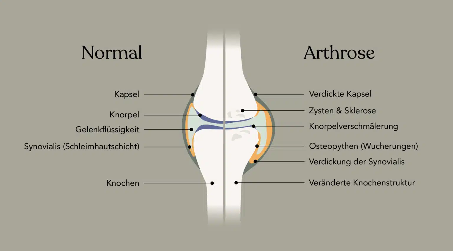 Arthrose verstehen: Die wichtigsten Fakten und hilfreiche Tipps