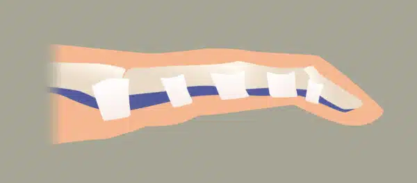 Schnappfinger – Ursache, Sympthome & Behandlung