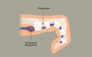 Schnappfinger – Ursache, Sympthome & Behandlung