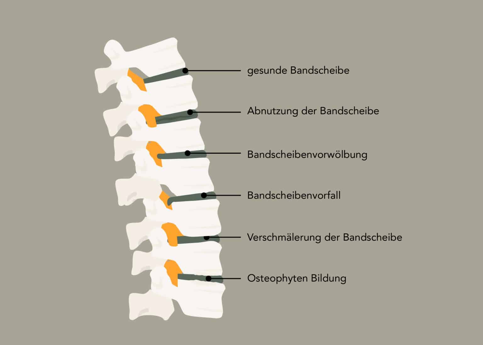 Ursachen, Symptome & Therapie der Wirbelsäulenarthrose