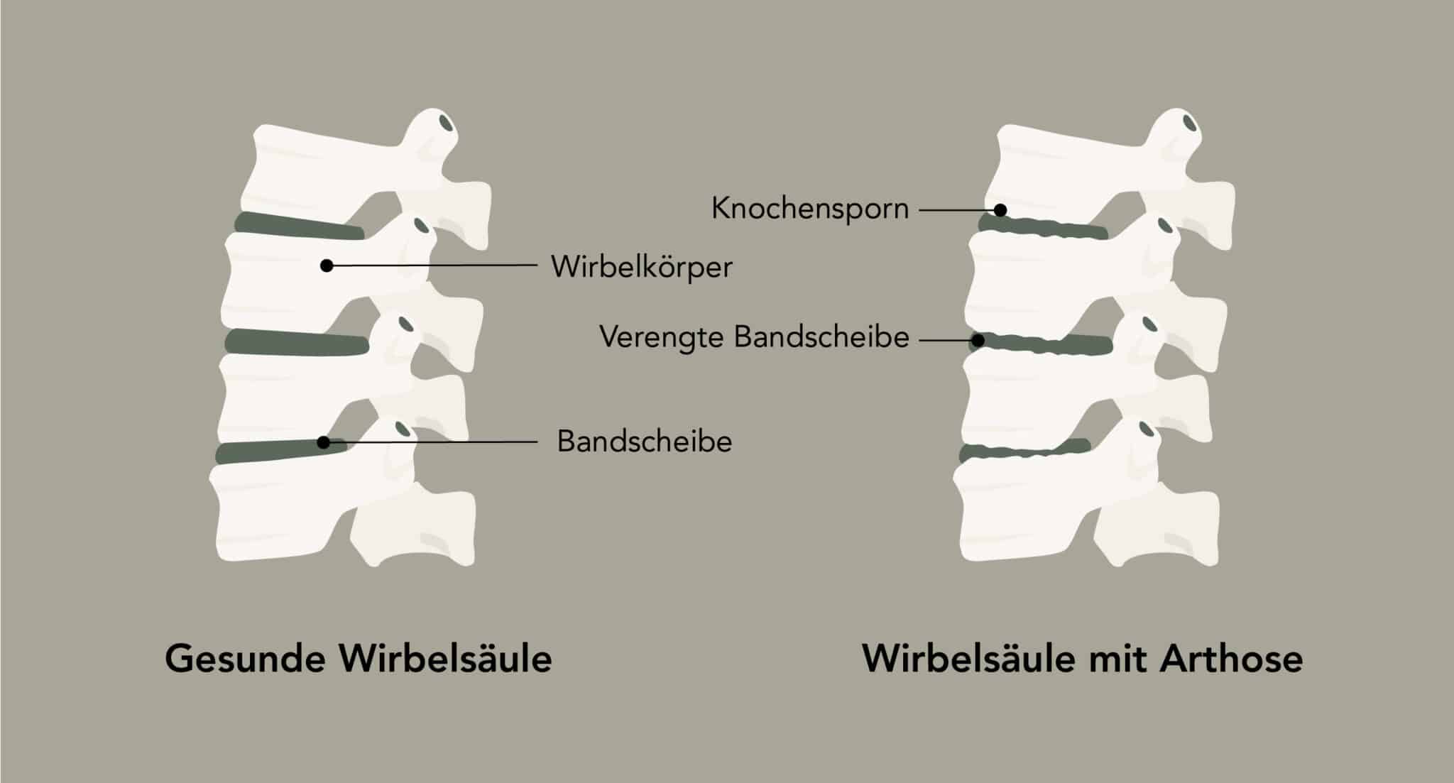 Ursachen, Symptome & Therapie der Wirbelsäulenarthrose